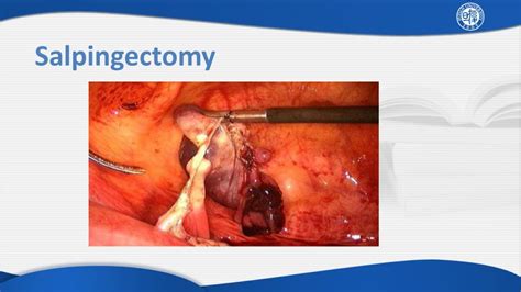 Ppt Ectopic Pregnancy Powerpoint Presentation Free Download Id 2176500