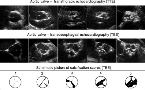 Aortic Valve Echo
