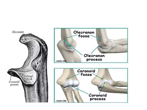 Olecranon Fracture Pptx