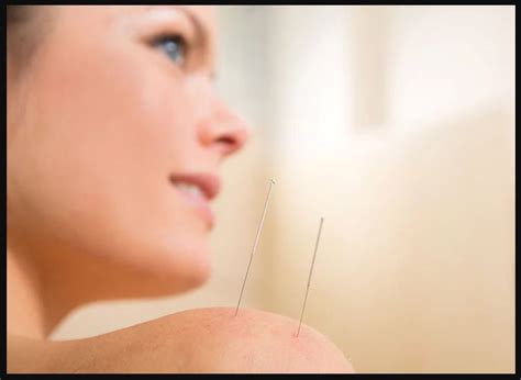 Acupuncture Benefits For Stroke Patients Acupuncturist Gainesville Fl