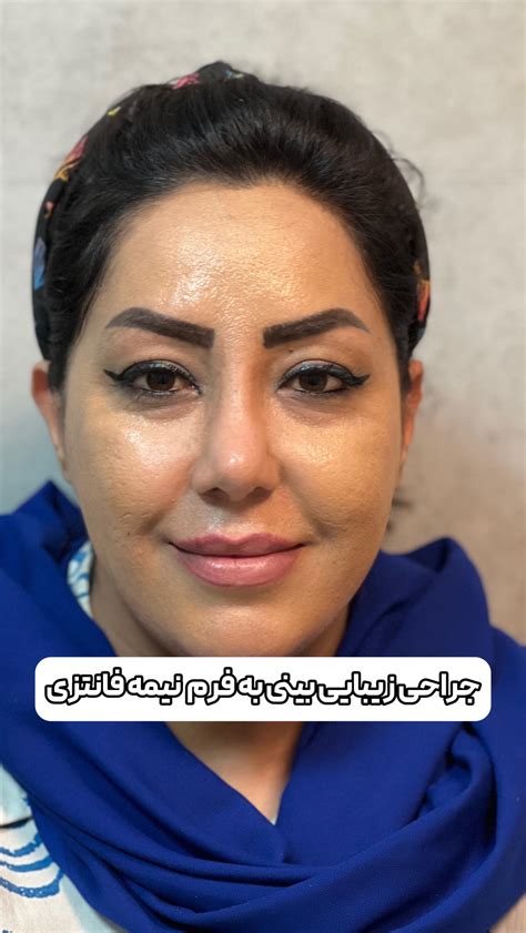 ‎دكتر نگار جعفرىجراحی زیبایی بینی شیراز‎ Drnegarjafari • Instagram Photos And Videos
