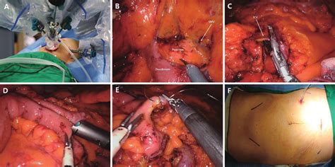 Figure2single Plus One Port Right Colectomy With Intracorporeal