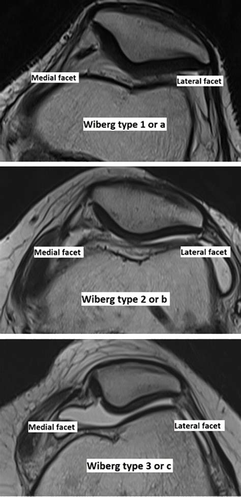 Patella Anatomy Facet