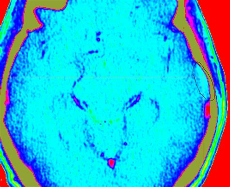 Evidence Damage To The Left Primary Auditory Cortex Rv2khelp