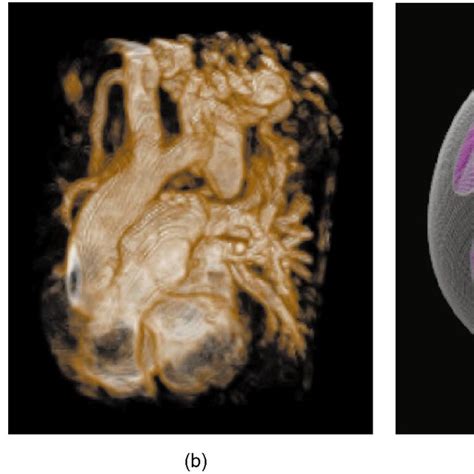 Direct Volume Rendering Vs Surface Rendering A Dvr Using A Rather