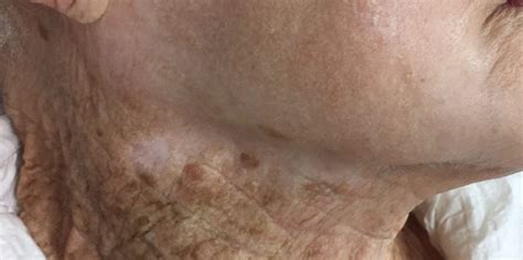 Photo Of 92 Year Olds Face And Neck Shows 40 Years Of Sun Damage