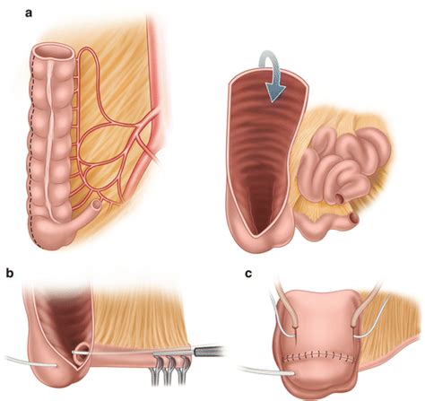Urinary Diversion Open And Robotic Techniques Springerlink