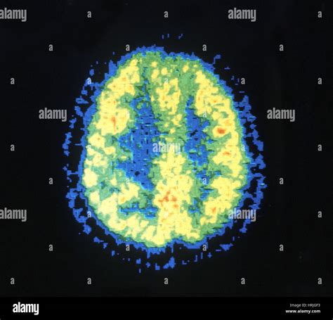 Pet Scan Brain High Resolution Stock Photography And Images Alamy