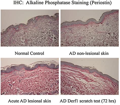 Localization Of Periostin In Lesional Skin In Atopic Dermatitis Ad Download Scientific