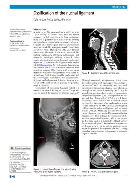 Ossification Of The Nuchal Ligament Bmj Case Reports