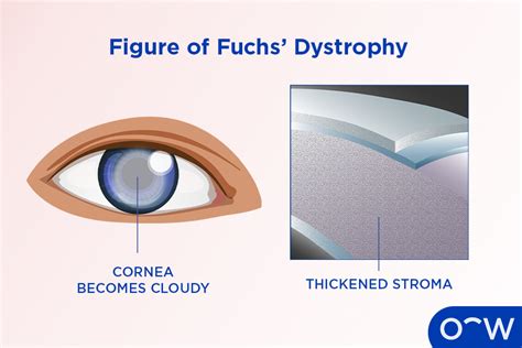 Fuchs Dystrophy Car Lights Fuchs Dystrophy Brisbane Ophthalmologist
