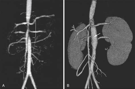 Arterial Bypass For Chronic Mesenteric Ischemia Thoracic Key