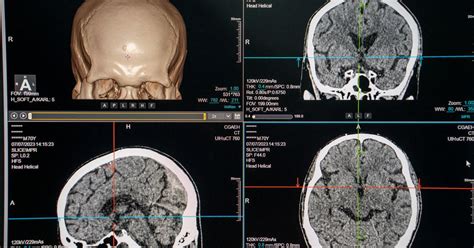Brain Implants That Decode Language Directly Rtsch Archyde