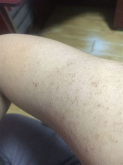 手臂上长褐色斑点手臂上长红色斑点 伤感说说吧