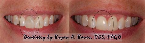 Front Tooth Root Canal