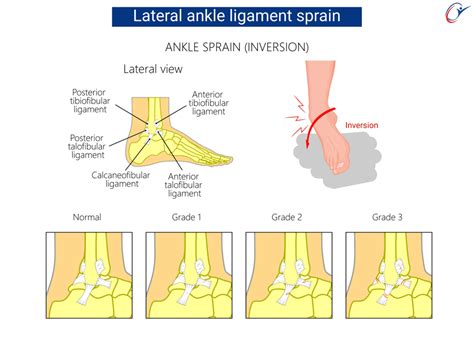 Volleyball Sport Science Injuries Lower Limb Ankle And Foot Ankle