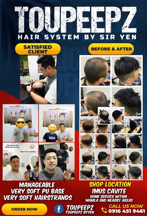 Scalp Solution Ph Scalp Micro Tattoo On Alopecia In Progress Smp Scalp Solution Ph Scalp Micro Tattoo On Alopecia In Progress Smp