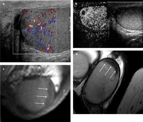 Figure 1 From Segmental Testicular Infarction Role Of Imaging Semantic Scholar