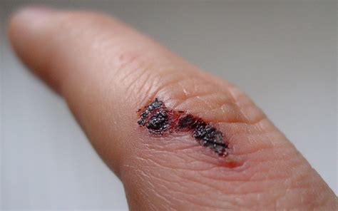 30 Facts About Exudate