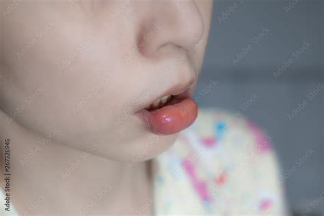 Closeup Swollen Lip Of Asian Woman Caused By Insect Bite Insect Sting