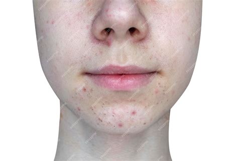 Лицо подростка с прыщами на коже на белом фоне Премиум Фото