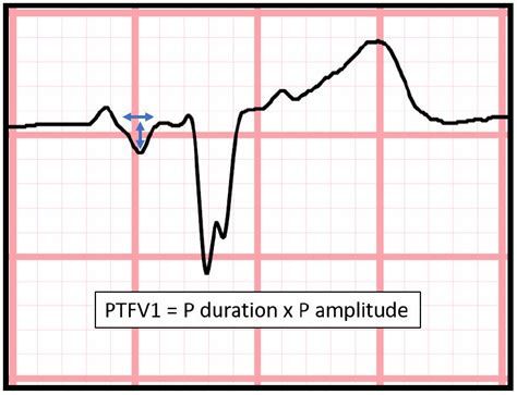 Component Variable Measurements Of The Mvp Ecg Risk Score P Wave Download Scientific Diagram