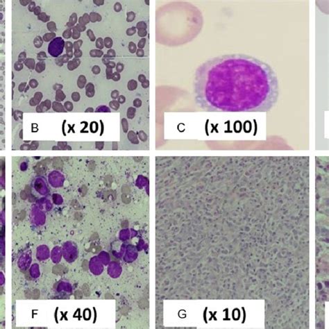 Flow Cytometric Fcm Examination Of Peripheral Blood Showed 40