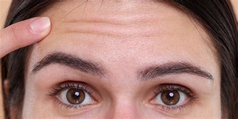How To Reduce Forehead Lines And Wrinkles Without Injectables