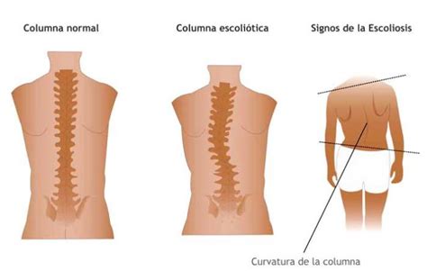 Que Significa Escoliosis Lumbar De Convexidad Izquierda Wgkpse
