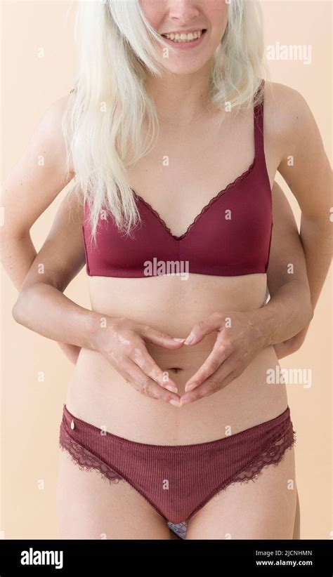 Body Positivity And Acceptance Love Dermatitis Scleroderma Latin Mexican And Honduran Friends