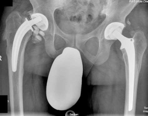 Traumatic Ceramic Femoral Head Fracture An Initial Misdiagnosis