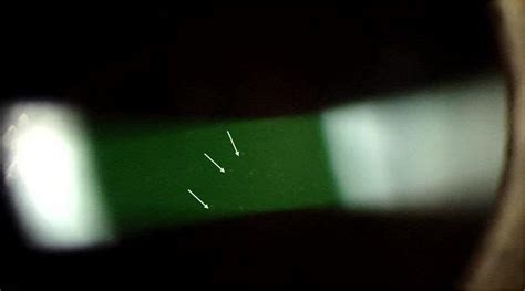 Anterior Uveitis Viewpoint