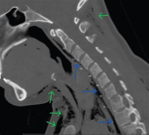 Postpartum Spontaneous Pneumomediastinum Role Of Patient Position In