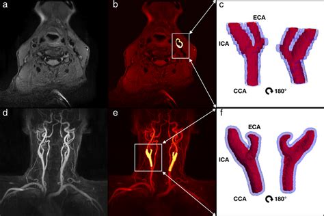 Example Segmentations Example Manual Segmentation Of The Carotid