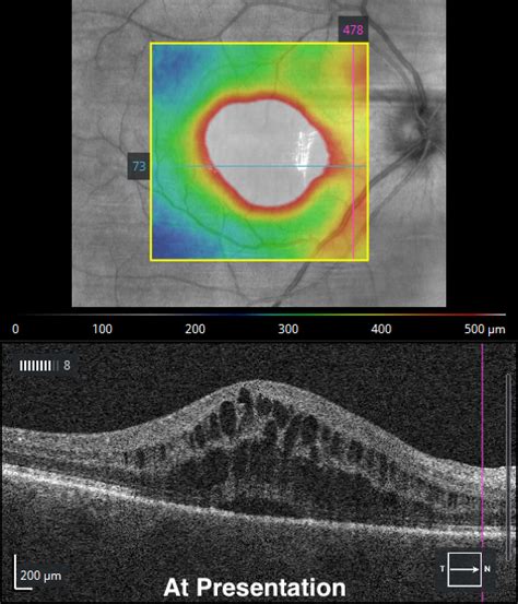 Treating Postoperative Cystoid Macular Edema Then And Now Eyecarepd