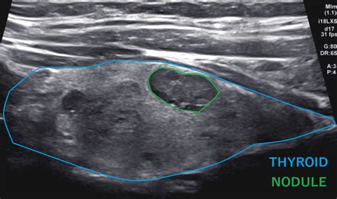 Thyroid Ultrasound Nodule