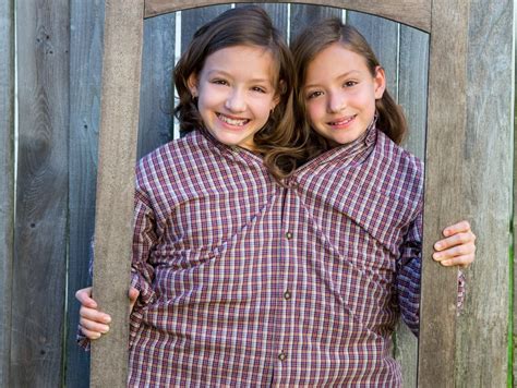 From Two To One Conjoined Twins Extraordinary Transformation Into Independent Individuals