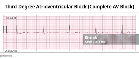 Ecg Third Degree Atrioventricular Block Complete Av Block 8 Second Ecg