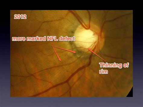 Imaging In The Detection Of Glaucoma Ppt Eye And Vision Conditions Diseases And Conditions