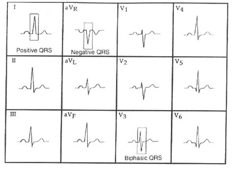The Normal ECG
