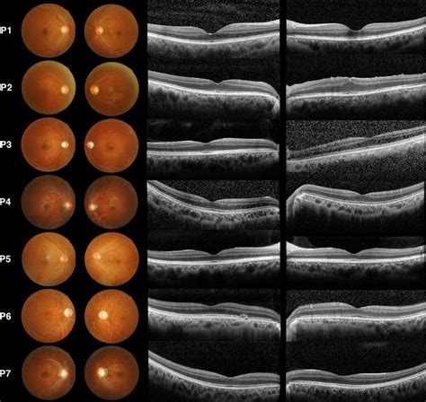 Color Fundus Photography And Macula Sd Oct In Patients With Lhon