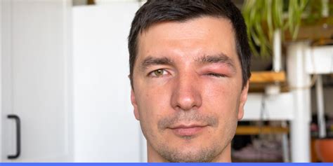 What Is Dacryoadenitis Klarity Health Library