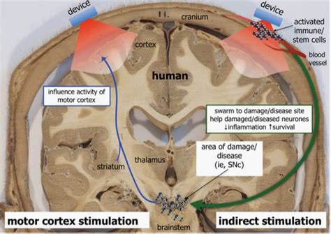 Exploring The Use Of Transcranial Photobiomodulation In Parkinsons Disease Patients Pmc