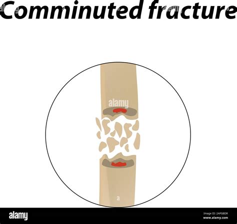 Comminuted Fracture Hi Res Stock Photography And Images Alamy