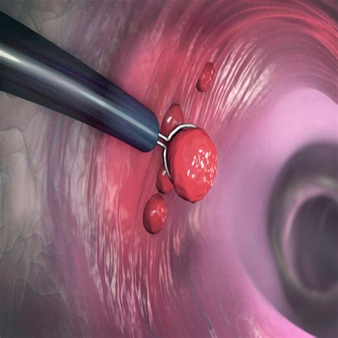 Рак Уретры У Женщин Фото — Картинки фотографии