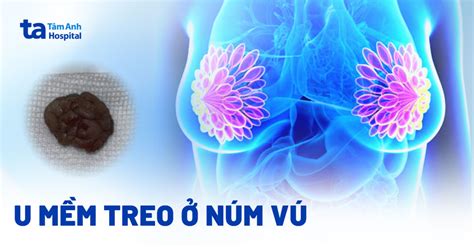 U Mềm Treo ở Núm Vú Nguyên Nhân Dấu Hiệu Chẩn đoán Và điều Trị