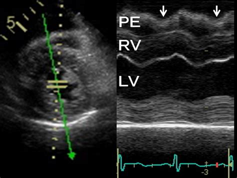 M Mode Echocardiography Reveals The Diastolic Collapse Of The Right Download Scientific Diagram