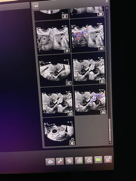 Submucosal Fibroid And Adenomyosis R Fibroids