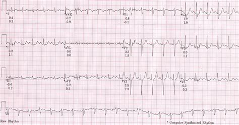 Treadmill Exercise Test ECG Series Shows Positive Response