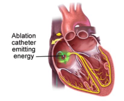 Atrial Flutter Hope For Hearts